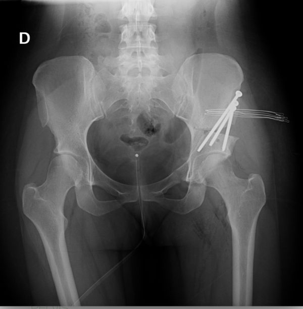 Displasia de cadera | Clínica CEMTRO