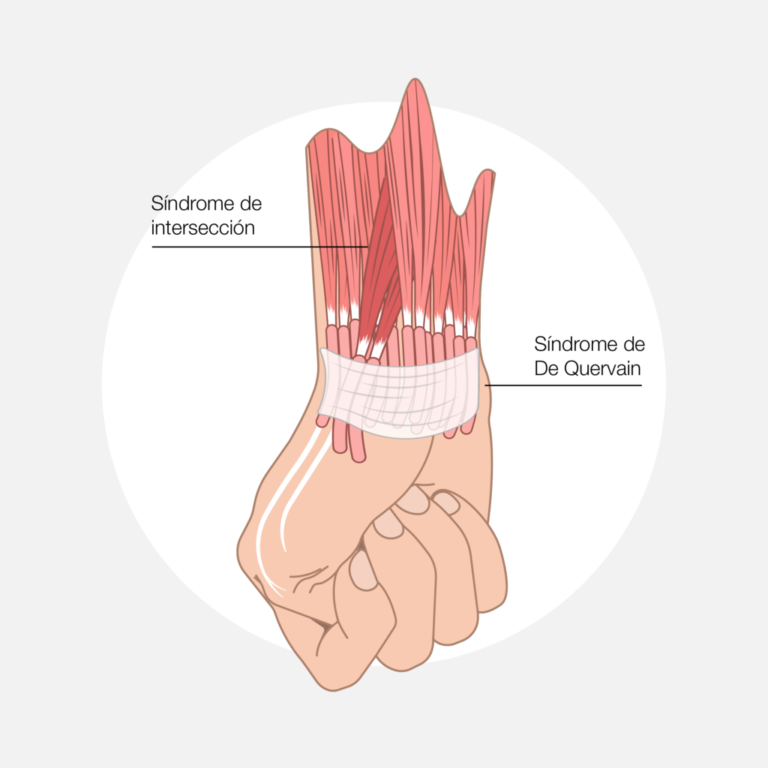 Tendinitis de muñeca: síntomas, tipos y tratamiento