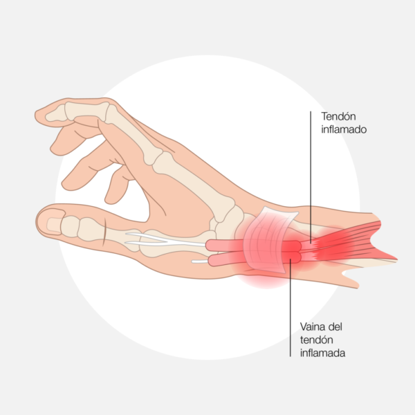 Tendinitis de muñeca | Clínica CEMTRO