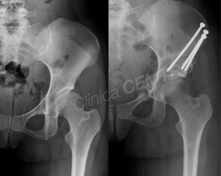 Osteotomía Periacetabular - Clínica CEMTRO